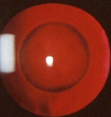 Medicine Decoded: Cataracts-Few interesting types